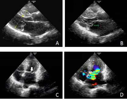 Transaortic Shallow Septal Myectomy with Mitral Valve Repair in ...