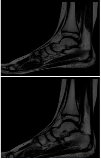 Clinical Presentation and Management of Trigonum Bone Syndrome in a ...