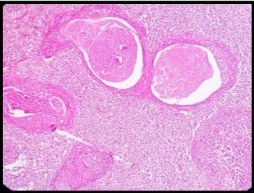 Cytodiagnosis of Primary Hodgkin’s Lypmhoma arising in Warthin’s Tumour