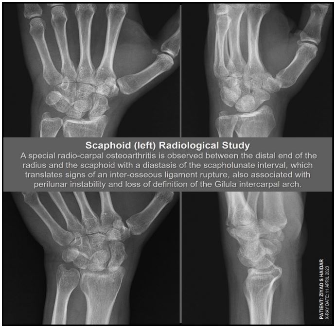 Carpal Tunnel Syndrome and SLAC: Implications for Oro-Dentists and ...