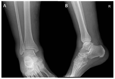 Misdiagnosed a Locally Aggressive Solitary Fibrous Tumor of Lower Leg ...