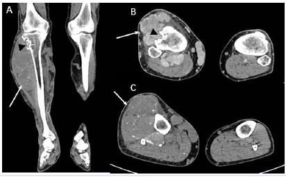 Misdiagnosed a Locally Aggressive Solitary Fibrous Tumor of Lower Leg ...
