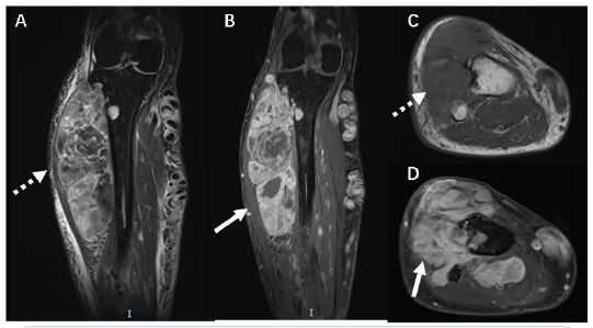 Misdiagnosed a Locally Aggressive Solitary Fibrous Tumor of Lower Leg ...