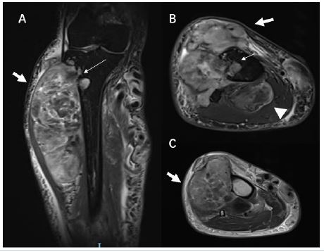 Misdiagnosed a Locally Aggressive Solitary Fibrous Tumor of Lower Leg ...